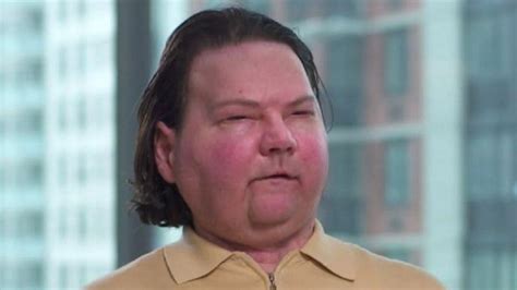 Primeiro Transplante Bem Sucedido De Rosto E Mãos A História De Joe Dimeo Aventuras Na História