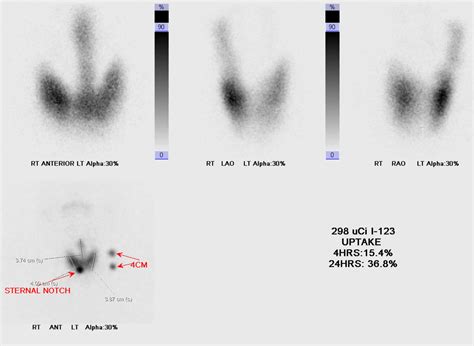 Radioactive Medicine For Thyroid At Peter Kimmons Blog