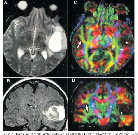 Figure 1 From Diffusion Tensor Imaging Of White Matter Tracts In