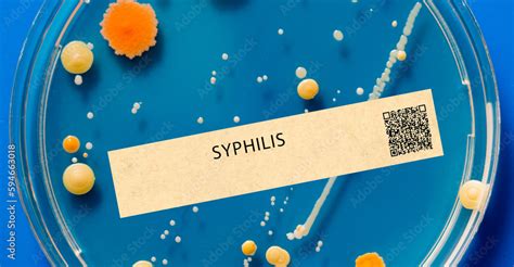 Syphilis Sexually Transmitted Bacterial Infection That Can Cause