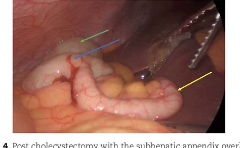 Figure 1 From An Unusual Case Report Of A Subhepatic Appendix And An