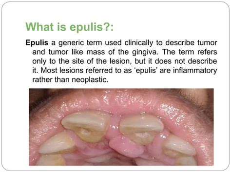 Case Presentation On Epulis Pptx Dental Health Diseases And
