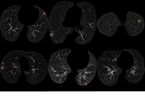 Lung Detr Deformable Detection Transformer For Sparse Lung Nodule Anomaly Detection