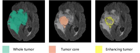 Spatial Relationship Of Different Sub Regions In Glioma Download Scientific Diagram