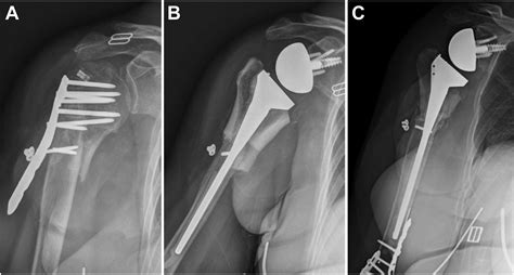 Management Of Proximal Humerus Bone Loss With Allograft Prosthetic