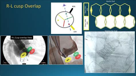Essentials Of Lifetime Management In Patient Undergoing Tavi Using Novel Balloon Expandable