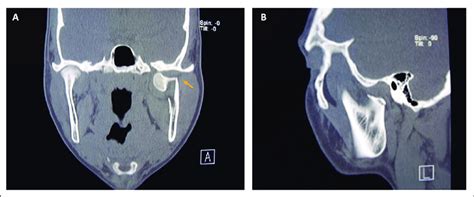 Tc Fractura De Cóndilo Mandibular Izquierdo A Corte Coronal