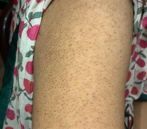 Laser Hair Removal Keratosis Pilaris Before And After At Alannah Macquarie Blog
