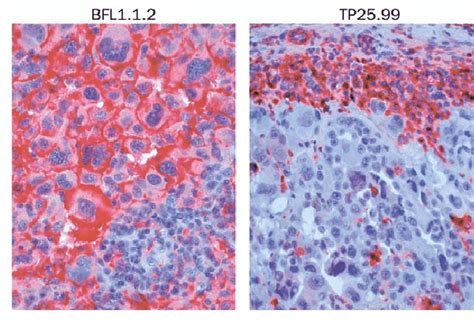 Expression On Melanoma Cells Metastatic To The Locoregional Lymph Node Download Scientific