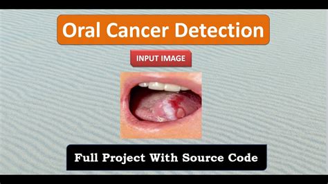 Oral Cancer Detection Using Image Processing With Source Code Oral Cancer Detection Using Cnn