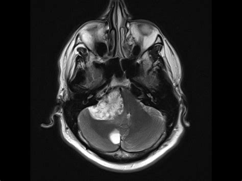 Radiology Vestibular Schwannoma At Jeff Updike Blog