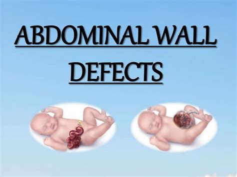 Abdominal Wall Defect Pptx