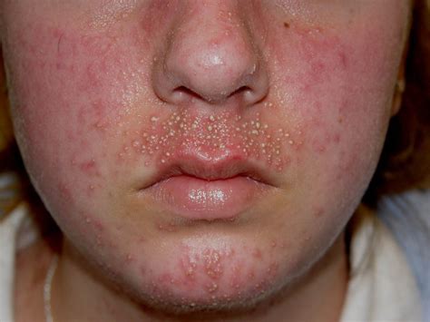 Treatment For Acne Conglobata Healthy Skin Journals