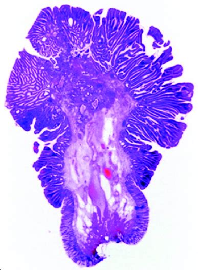 A Malignant Polyp Stained With Hematoxylin And Eosin ×25 Download Scientific Diagram