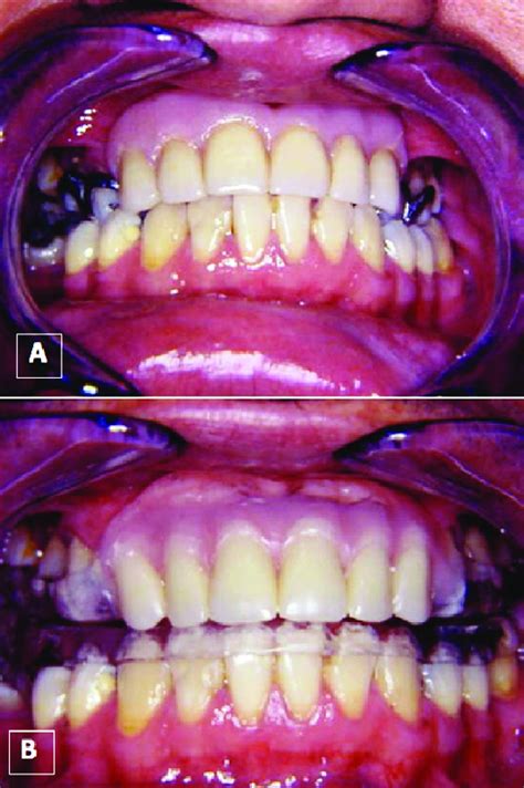 Occlusal Splint A Before And B After Installation Download Scientific Diagram