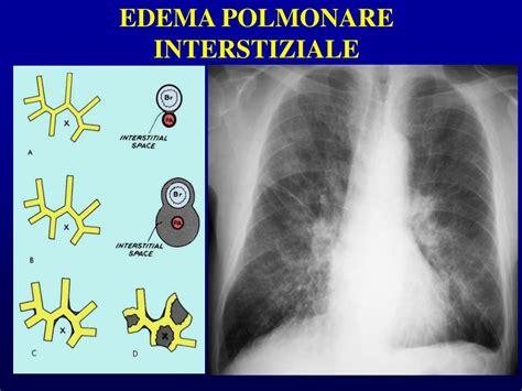 Ct Edema Polmonare Al Torace