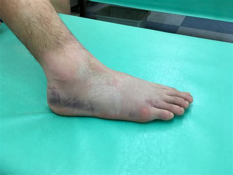 足首の捻挫で骨折してる？してない？？の判断の指標 │ 高石市東羽衣の阪本整骨院