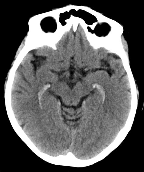 Radiopaedia Case Choroid Plexus Calcification Through The Foramina Of