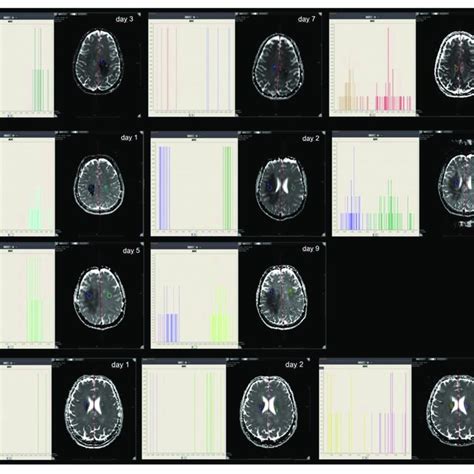 Mri In The Acute Phase Of Nmosd A Tumefactive Ms B And Ischemic