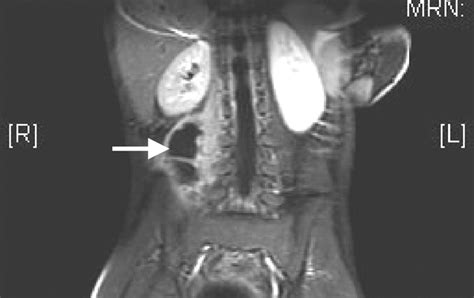 Psoas Abscess Mri