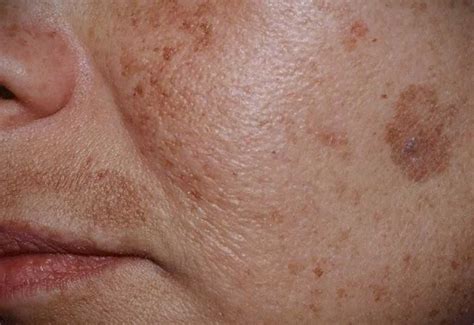 Пигментация кожи на лице руках декольте пигментные пятна