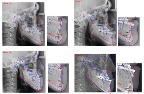 Examples Of Cephalometric Digitization In Severe Skeletal Class Iii