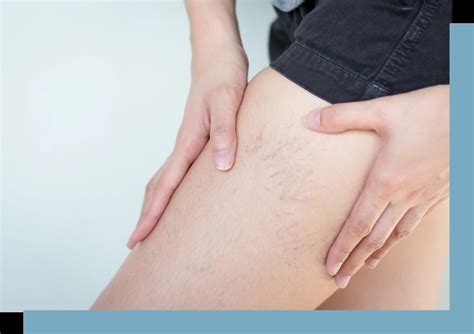Expert Foot Treatments In Nyc Non Surgical Foot Solutions