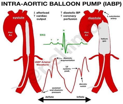 A Page Nursing Cheat Sheet For Intra Aortic Balloon Pump Iabp My Xxx
