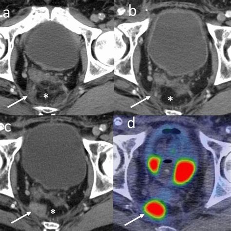 Lateral Recurrence A 60 Year Old Male Underwent Low Anterior Resection Download Scientific
