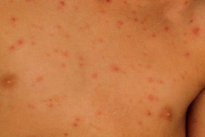 Chickenpox Rash When Is Chickenpox Contagious Key Signs Youre Still