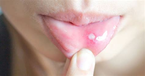 Khi Nào Nổi đẹn Là Nghiêm Trọng