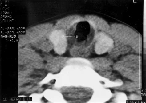 Computed Tomography Scan Showing Subglottic Stenosis Due To A