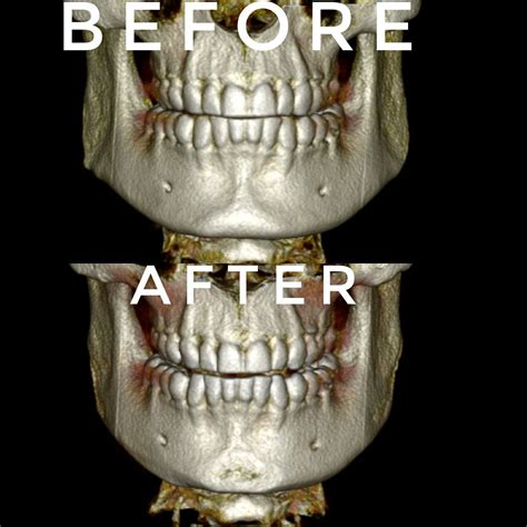 Facial Feminization Surgery Center Of Los Angeles Jaw And Mandible Contouring To Feminize The