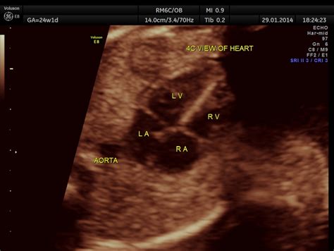 Choroid Plexus Cyst Looking Through A Transducer