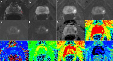 72 Year Old Man With Prostate Cancer Gs 3 4 7 Lesions In Left Download Scientific Diagram