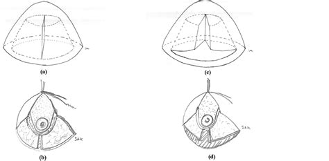 A New Technique For Mastopexy And Reduction Mammaplasty The Rolling