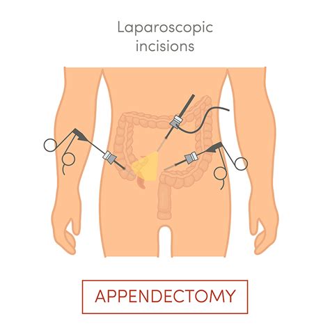 Laparoscopic Appendectomy Treatment Laparoscopic Surgeon In Chennai