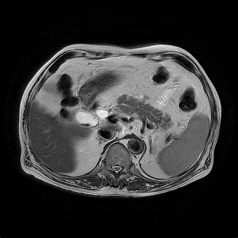 Choledocholithiasis Image