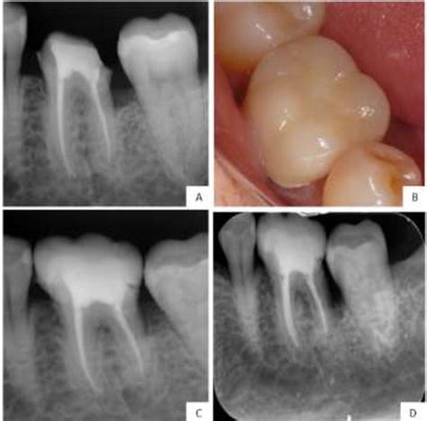 Final Stages Of Multidisciplinary Case Management A A Periapical Download Scientific Diagram