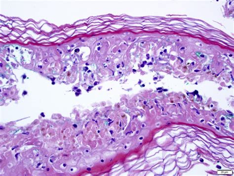 Pathology Outlines Stevens Johnson Syndrome