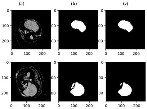 Sensors Free Full Text Automatic Liver Tumor Segmentation From CT Images Using Graph