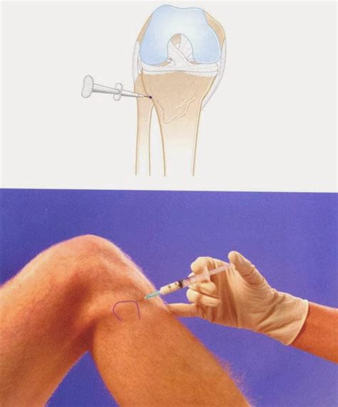 Superior Tibiofibular Joint Injection ~ Nursing