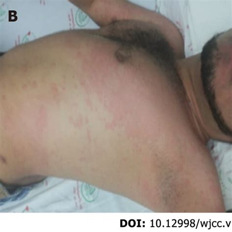 Classification Of Urticaria According To The World Allergy Download Scientific Diagram