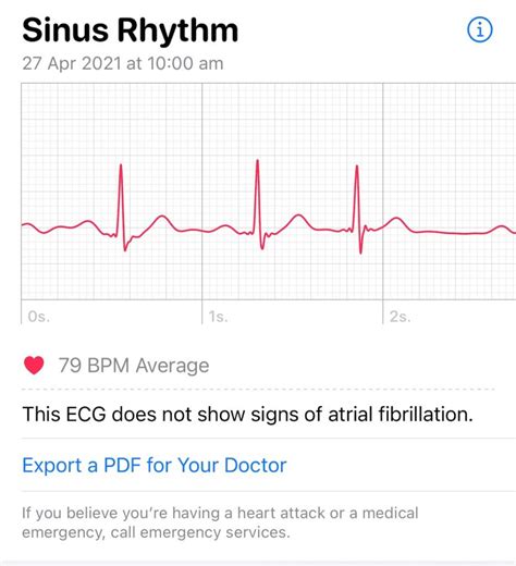 Ecg Now Available For Apple Watch Users Heres How You Can Activate It Tech Guide