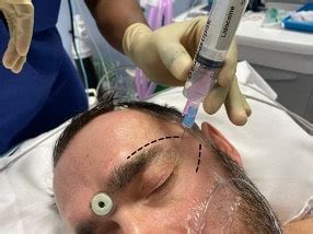 Scalp Block Technique And Applications Virtual Library