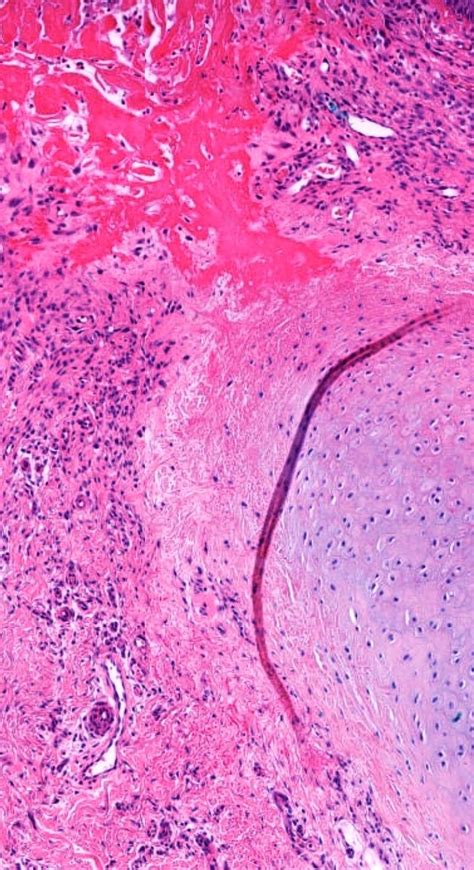 Pathology Of Chondrodermatitis Helicis Nodularis Pathology Blog