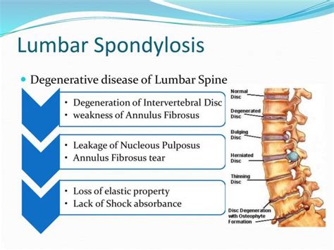 Lumbar Spondylosis And Sciatica At Weston Sayre Blog