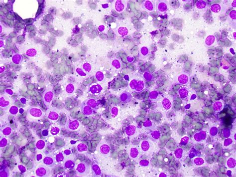 Amelanotic Melanoma Cytology