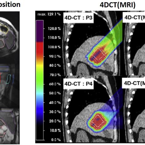 4d Mri In Treatment Planning 4d Mri Acquisitions With Contours Defined