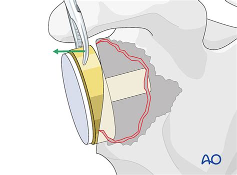 Revision Of An Anatomic Metal Backed Glenoid Component For Glenoid Implant Loose Poor Bone Defect